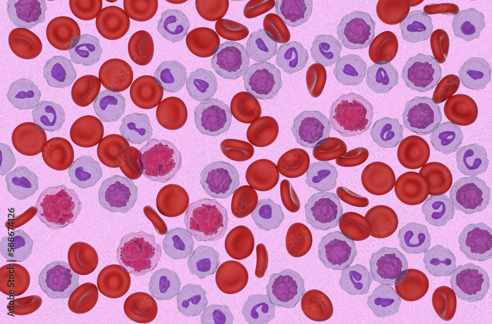 Acute lymphoblastic leukemia (ALL) cancer cell in blood flow ...