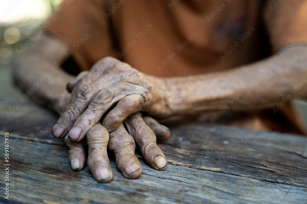 Old man hand with spots and rash from hand, foot and mouth disease ...