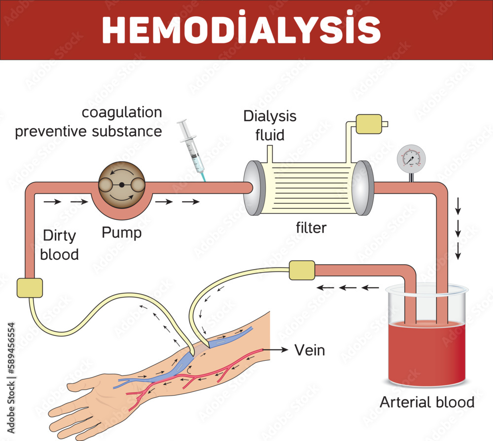 illustration of a hemodialysis device - Vascular access kidney graft ...