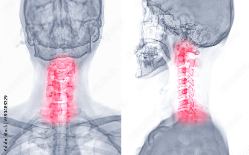 X-ray C-spine or x-ray image of Cervical spine AP and Lateral view for ...