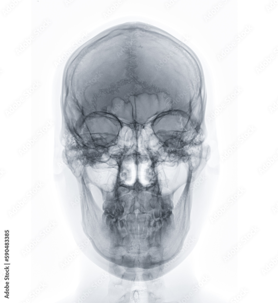 X-ray image of Human Skull Front view for diagnosis skull fracture ...