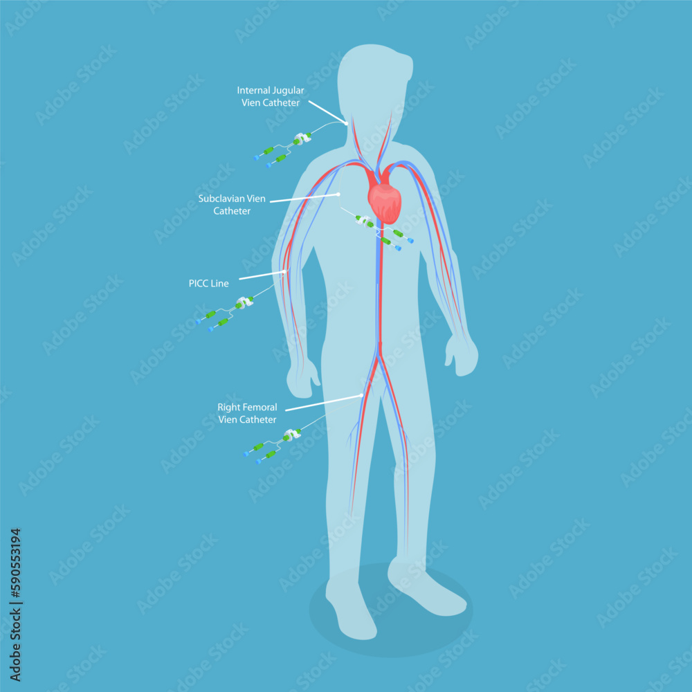 3D Isometric Flat Vector Conceptual Illustration of PICC Line , Central ...