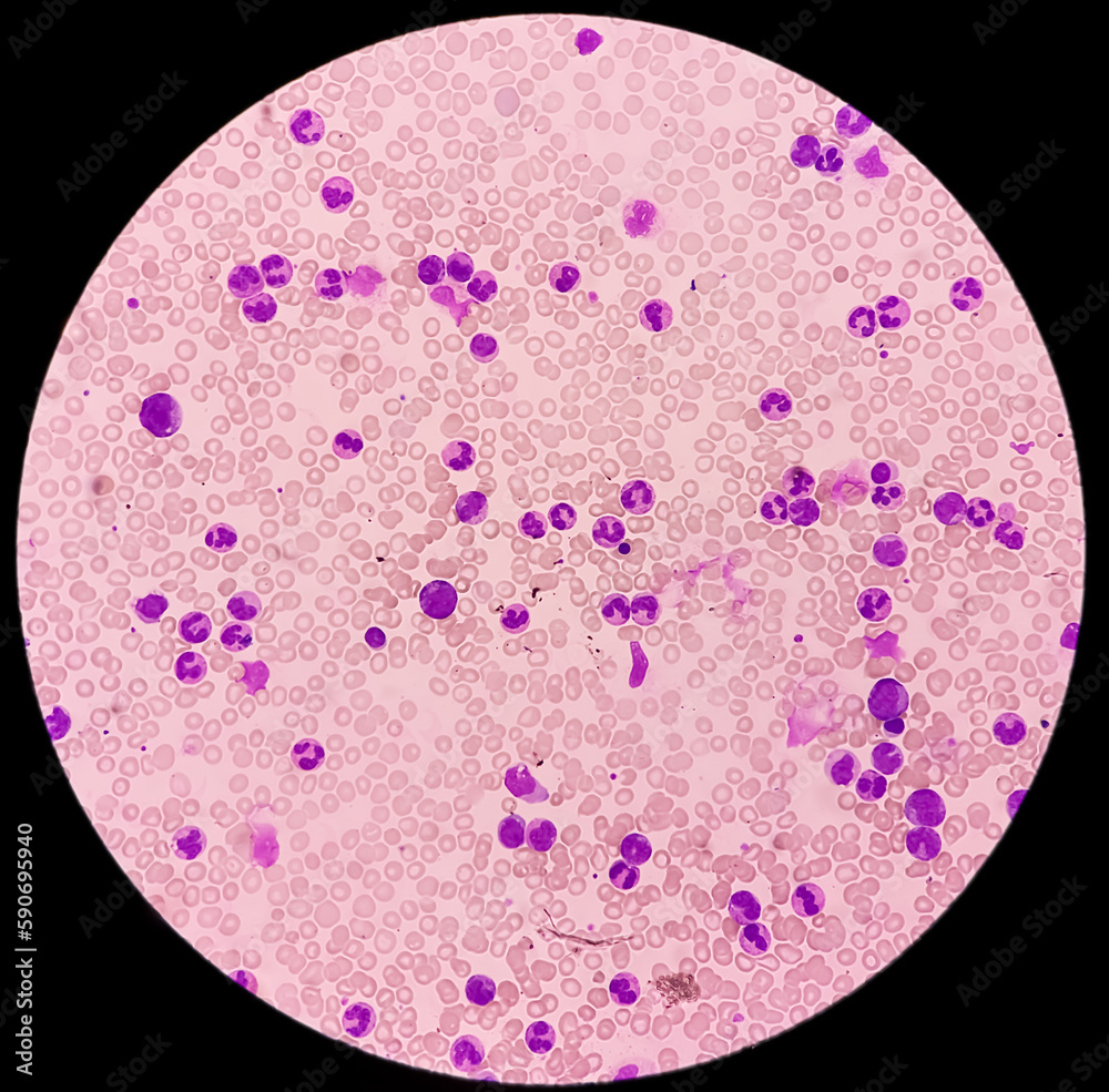 Blood cancer. Chronic myeloid leukemia(CML) with Thrombocytopenia ...