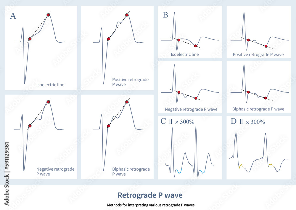 On the ECG, the retrograde P-wave can be a positive wave, a negative ...