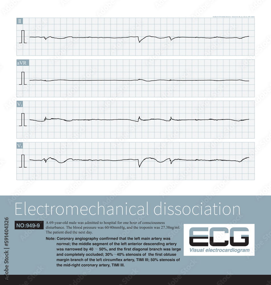 Electromechanical separation is a kind of terminal ECG. The patient's ...
