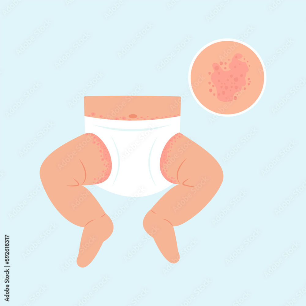 Baby with diaper rash, skin rash, allergy. Redness of skin in children ...