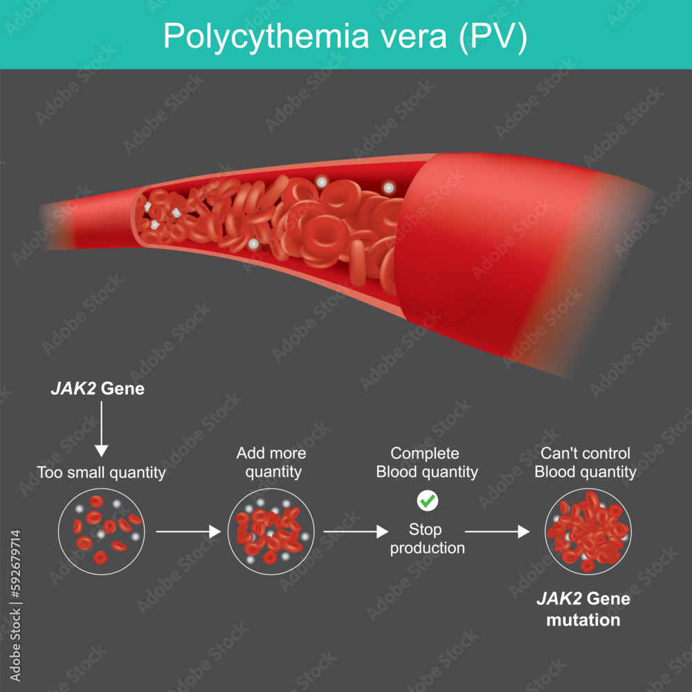 Polycythemia vera. Too much red blood cells have in blood vessel and ...
