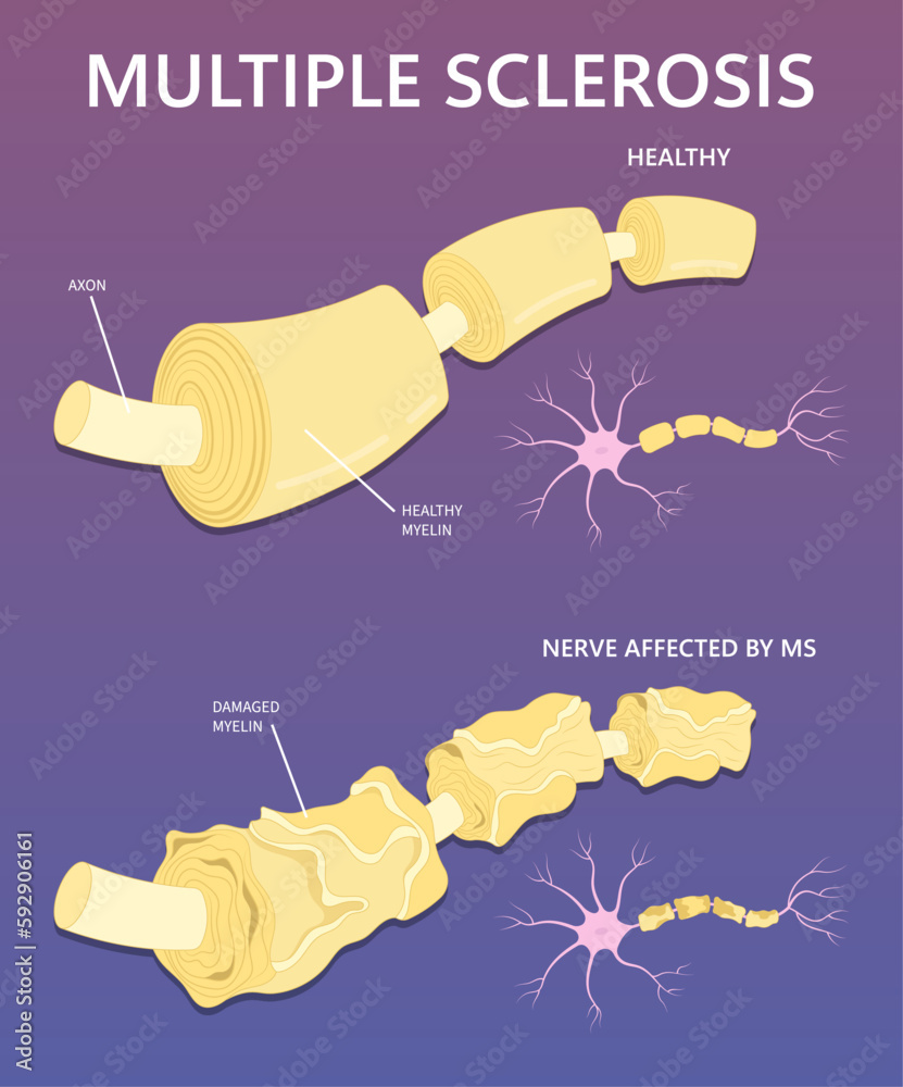 Amyotrophic lateral or demyelinating myelitis multiple sclerosis and Myasthenia Gravis systemic ...