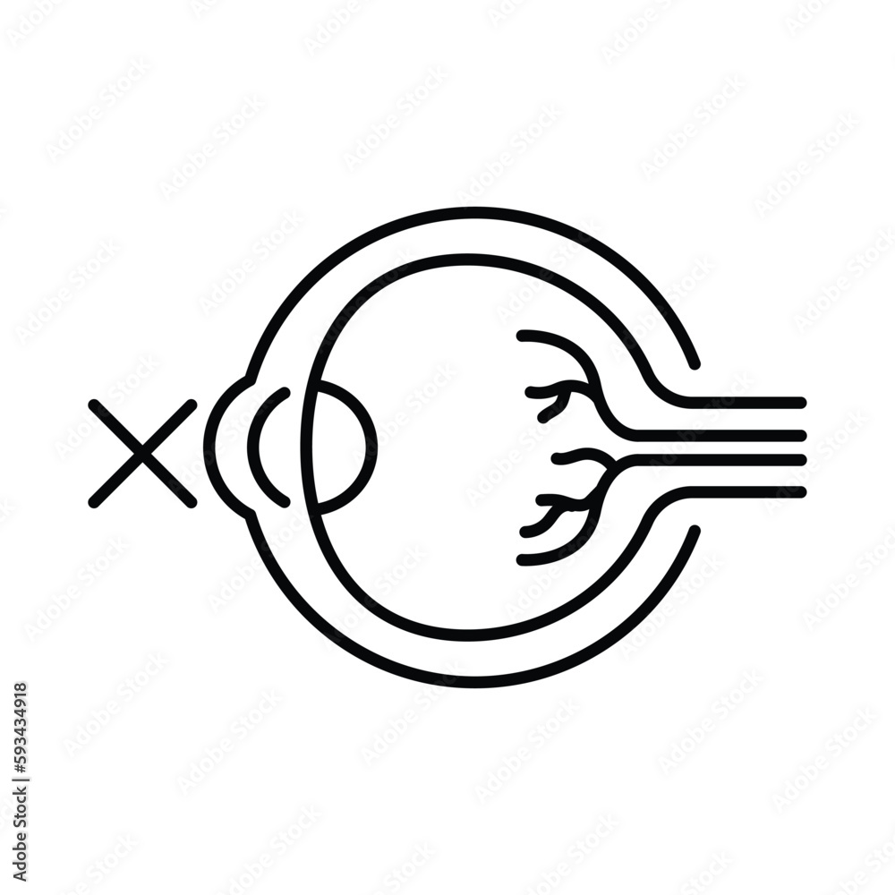 Diabetic eye icon design. Diabetic retinopathy vector. isolated on ...