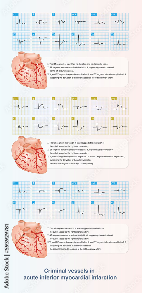Both left circumflex artery and right coronary artery occlusion can lead to acute inferior ...