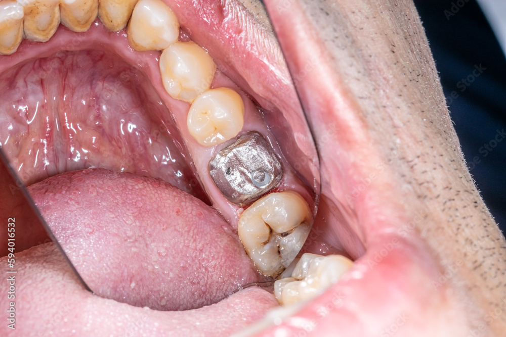 Mandibular arch with decayed molar crown destroyed and restored with ...