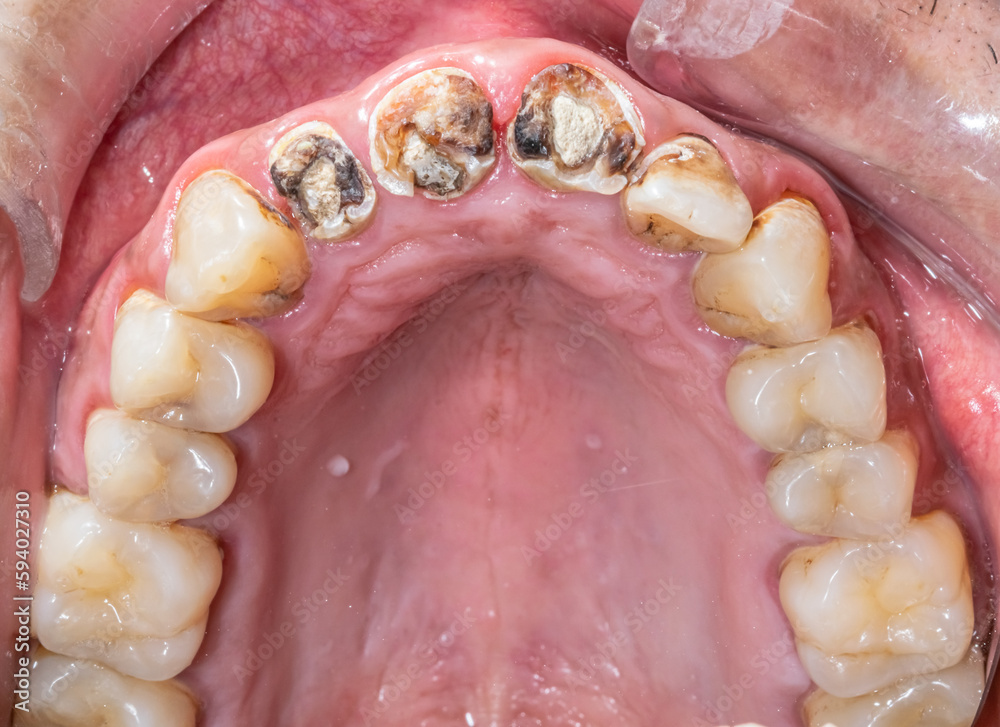 Photo Stock Occlusal view of maxillary arch with unhealthy gingival gum ...