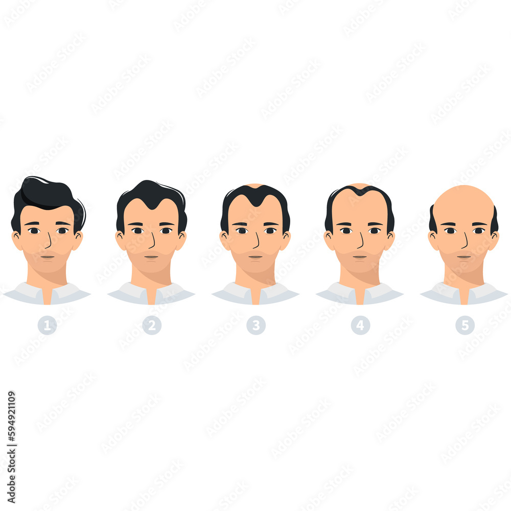 Hair loss stages, alopecia male pattern. Steps of baldness infographic ...