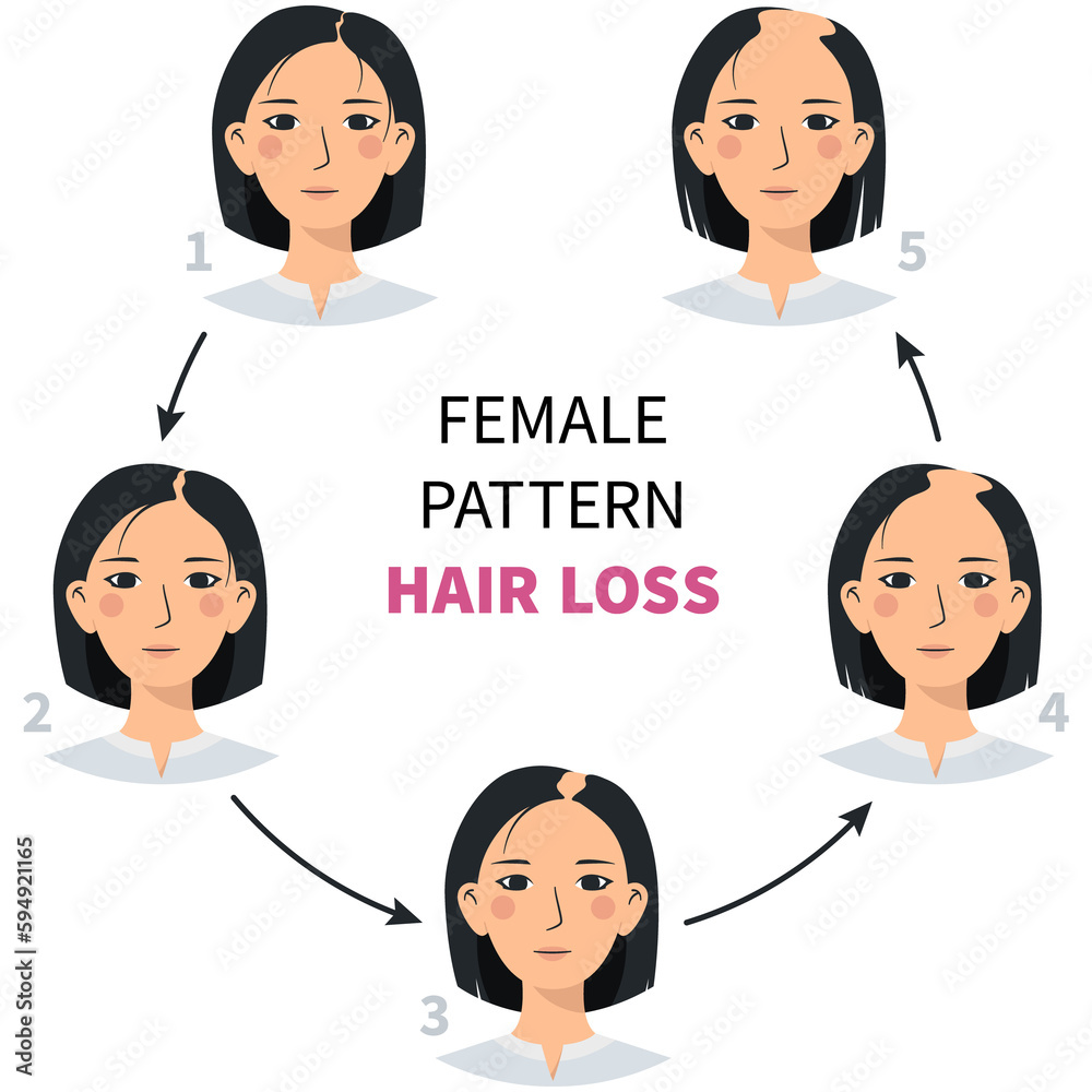 Hair loss stages, female androgenetic alopecia, steps of baldness flat ...