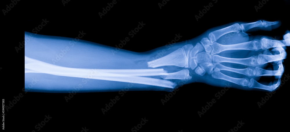 Forearm x ray after car accident in orthopedic unit inside trauma ...