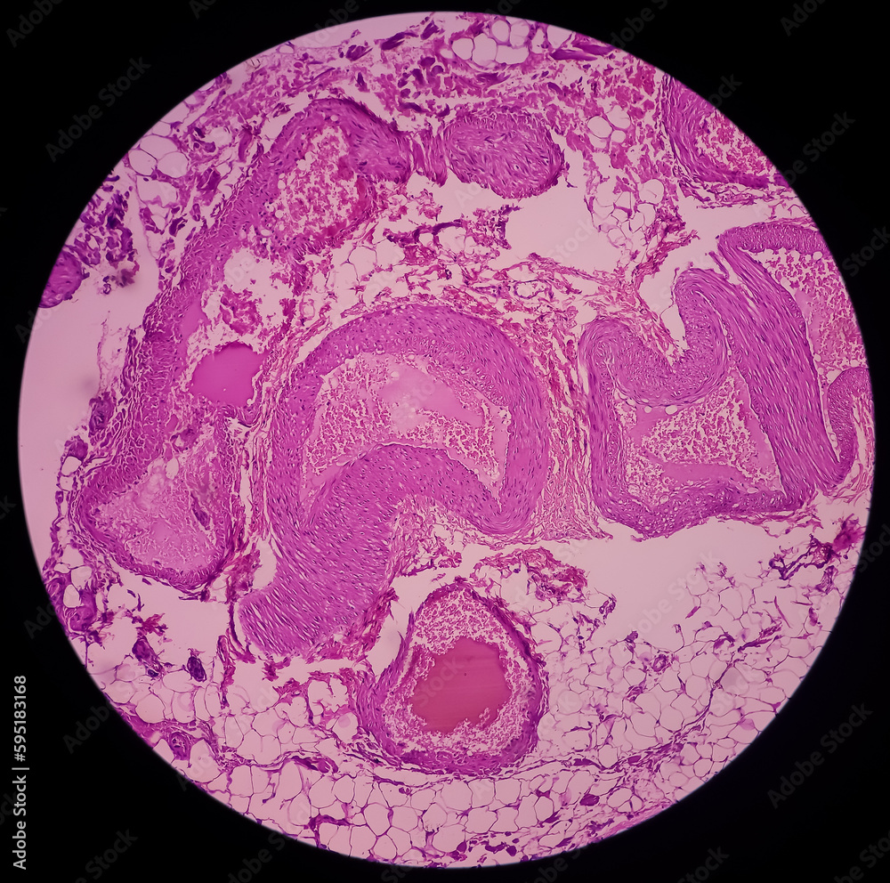 Foto de Stock Chronic anal fissure with fistula (histology): Fistulous ...