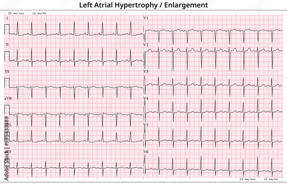 ECG Left Atrial Hypertrophy (LVH) - Left Atrial Enlargement (LAE) - 12 ...