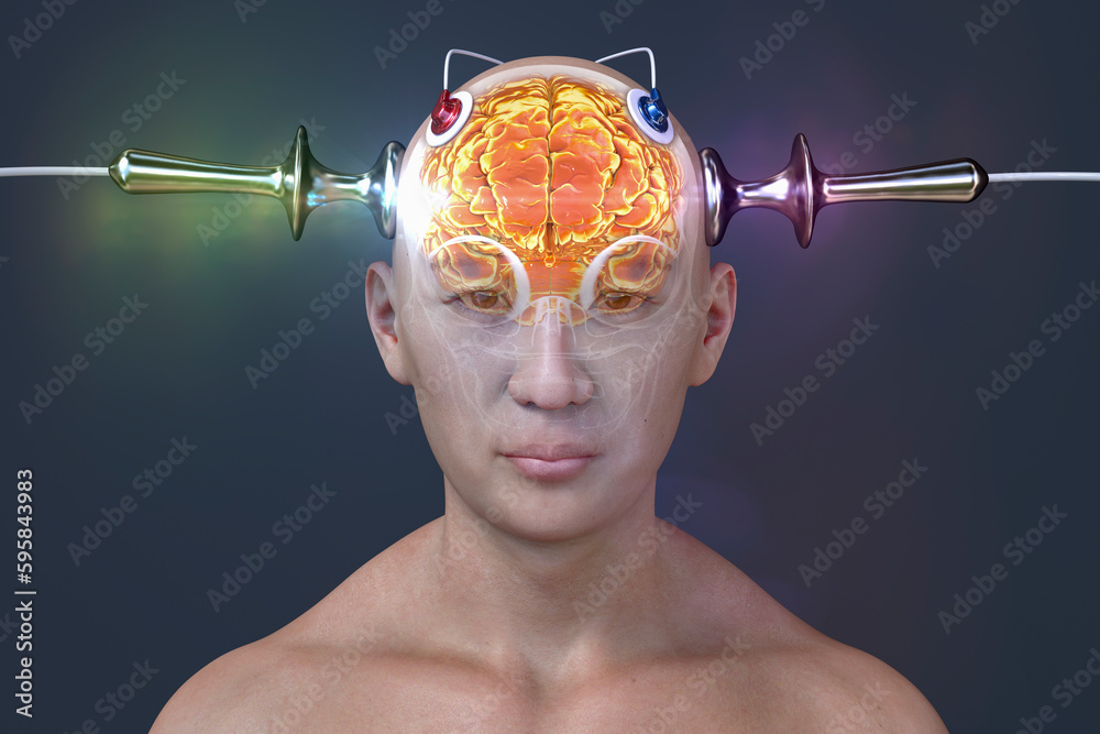 Stock-Illustration „Electroconvulsive therapy, ECT, a treatment ...