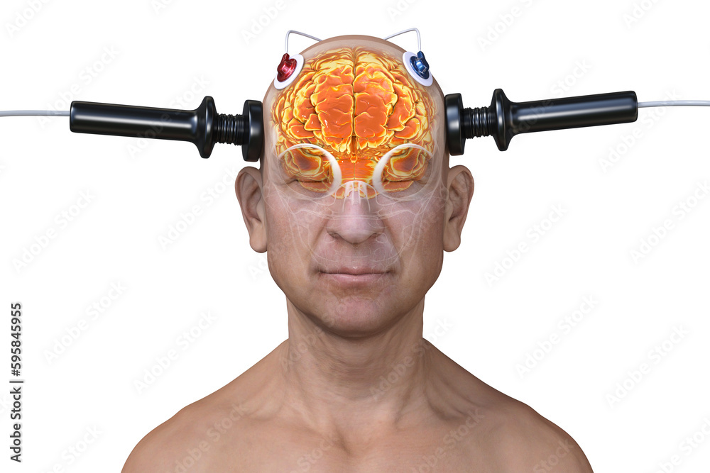 Electroconvulsive therapy, ECT, a treatment involving the use of ...