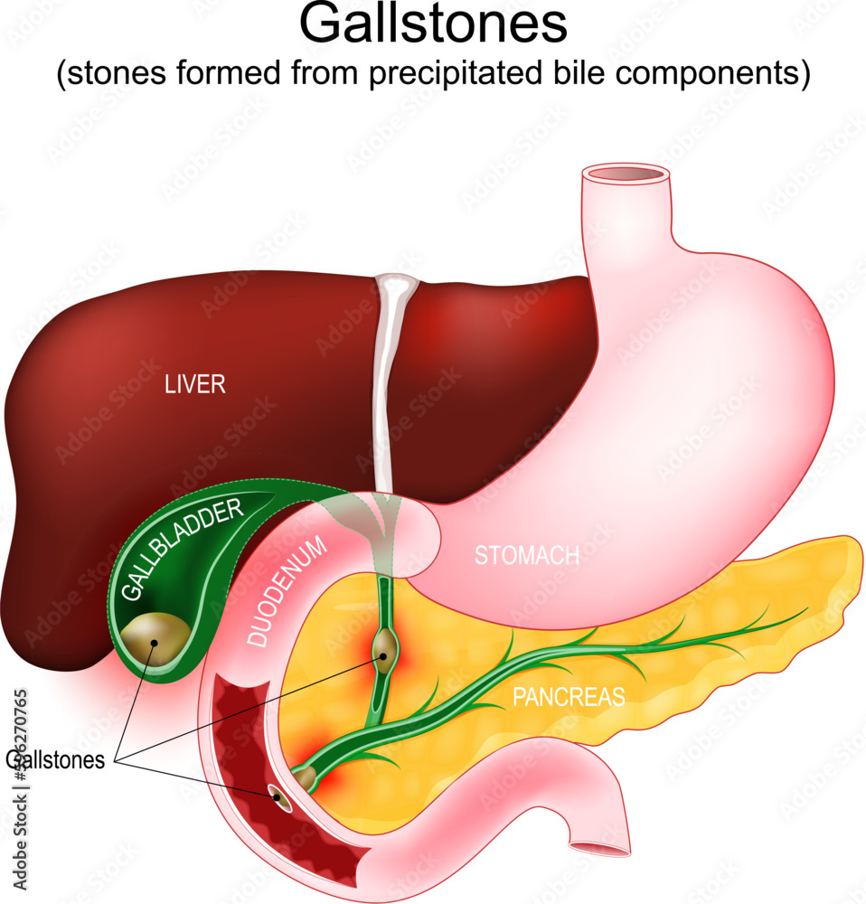 Gallstones. Parts of a digestive system: gallbladder, duodenum, stomach ...