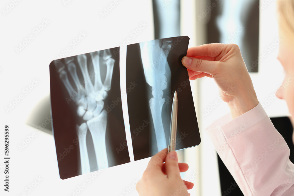 female doctor looks at x-ray of a arm injury in hospital. Sequelae of ...