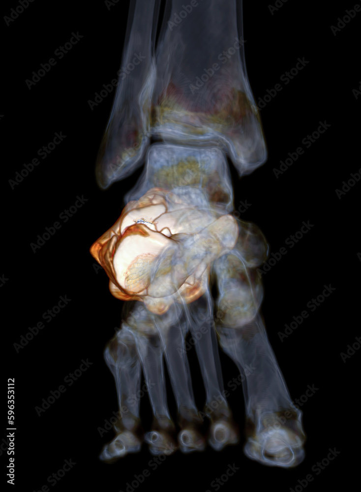 CT Scan ankle joint with 3d rendering of calcaneus bone showing ...