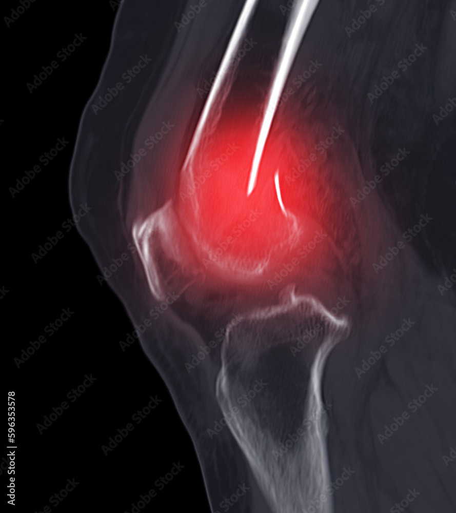 Ilustración de Stock CT scan of knee joint showing fracture of distal ...