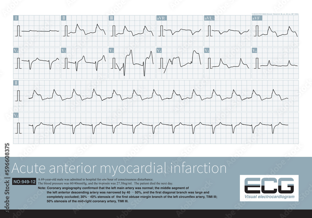 A 69 year old patient with acute myocardial infarction, whose ...