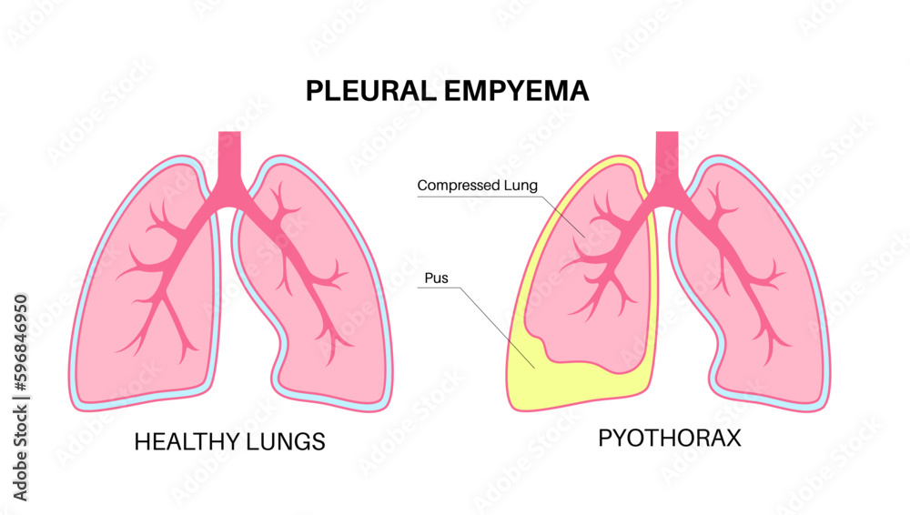 Pyothorax pleural empyema Stock Vector | Adobe Stock
