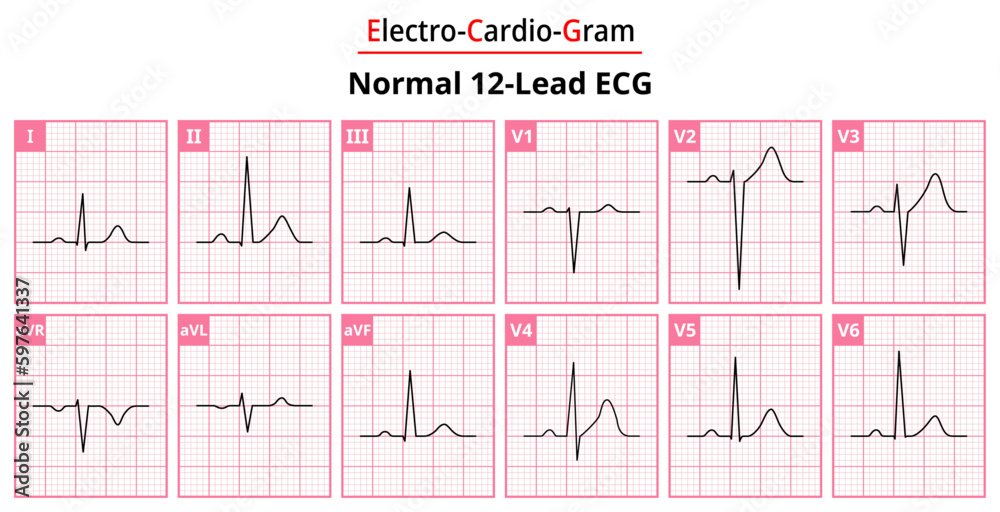Stock Vektorgrafik The Differences In Normal ECG Waveform For Each Of