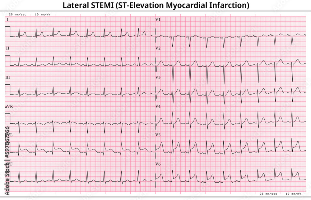 Lateral ST-Elevation Myocardial Infarction (STEMI) - 12 Lead ECG Common ...