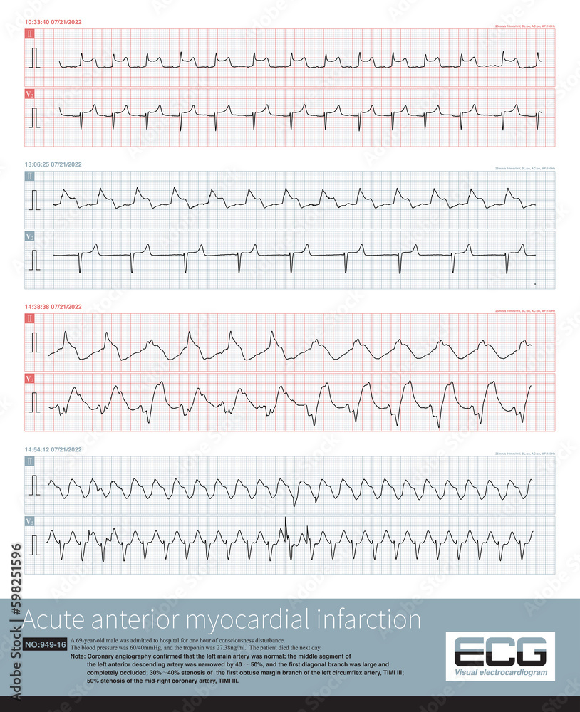 One patient with acute extensive anterior and inferior myocardial ...