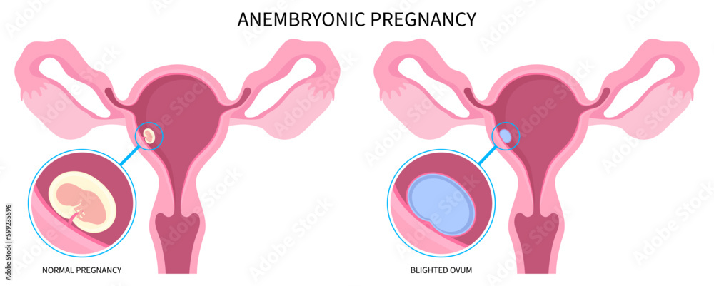 pregnancy loss missed abortion with Blighted ovum of anembryonic ...