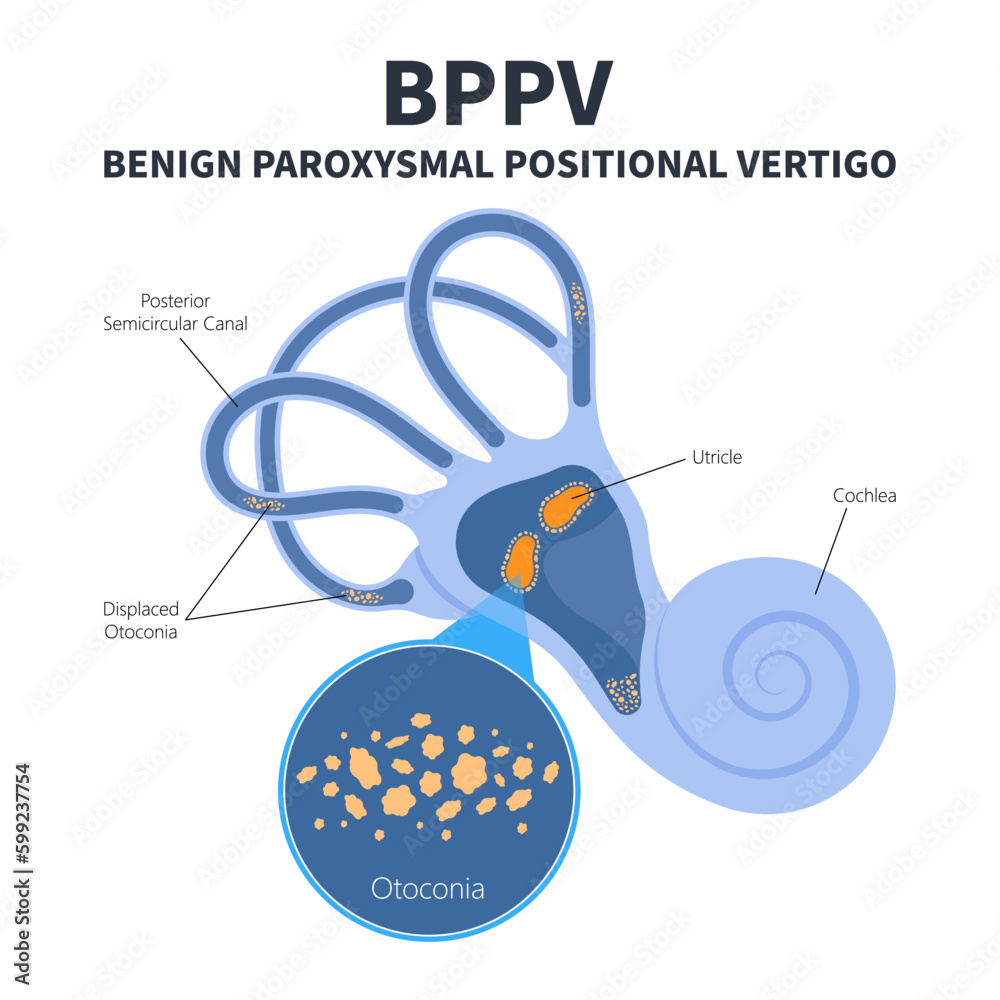 Otoconia Calcium or BPPV Loss Balance Dizzy Semicircular Meniere’s Ear ...