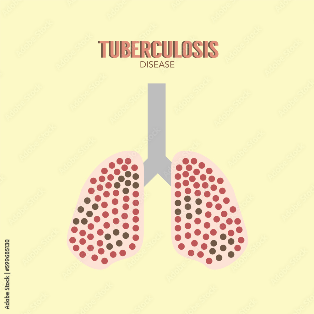 Lungs of infected person. Mycobacterium tuberculosis close-up ...