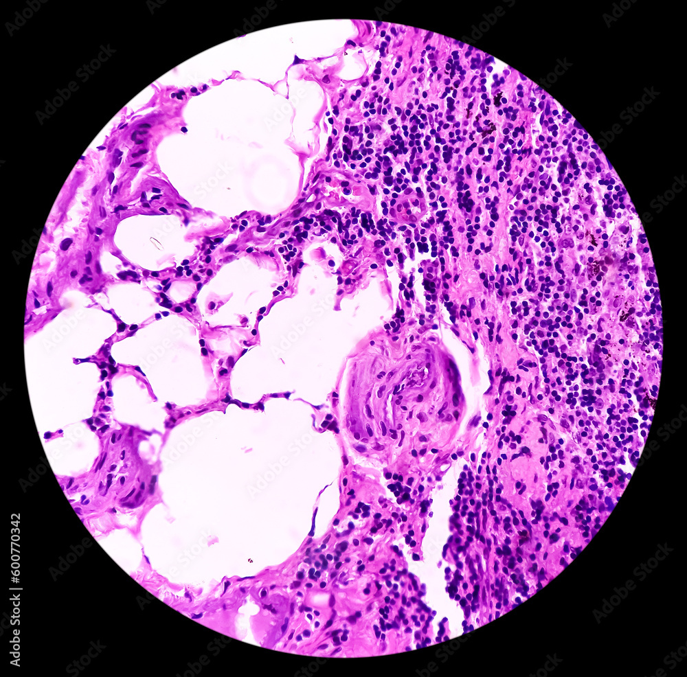 Lung cancer - adenocarcinoma, reactive change, lymph node show fibro ...