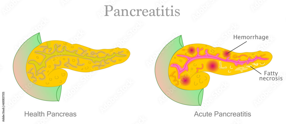 Stock-Vektorgrafik „Pancreatitis is inflammation of the pancreas. Gland ...