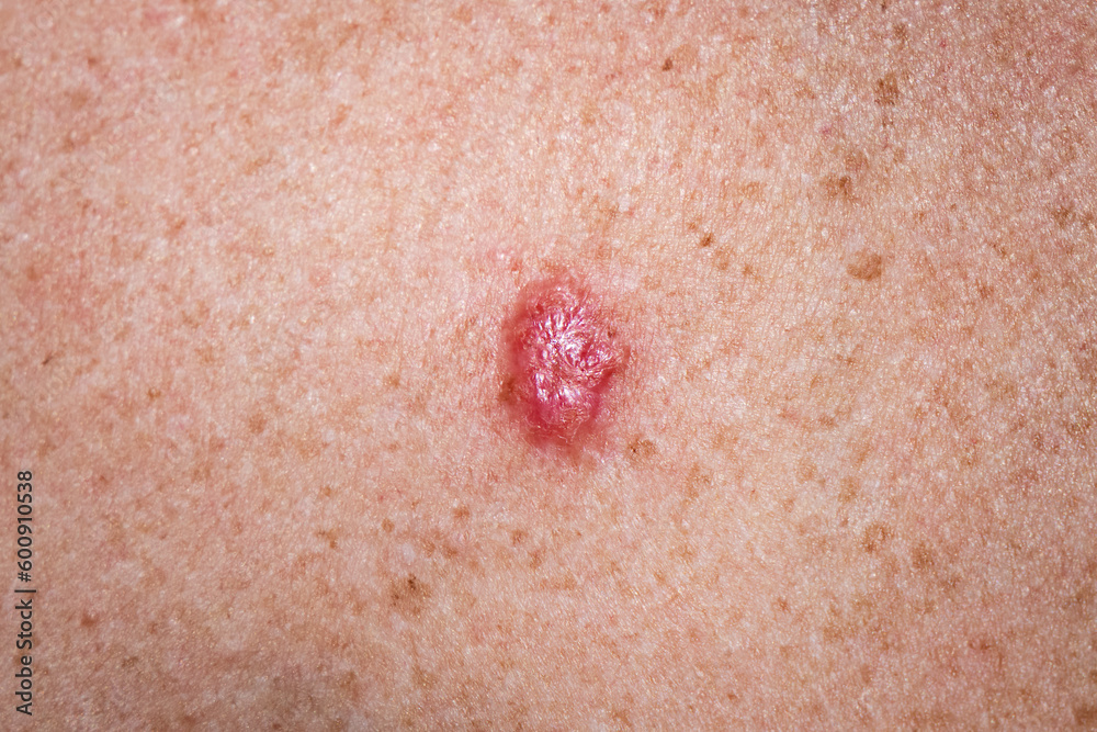 Young female 30s close up of chest prior to applying imiquimod cream ...