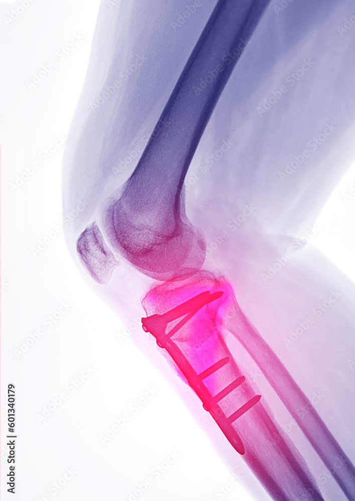 X-ray image of Right knee Lateral view showing Total knee arthroplasty ...