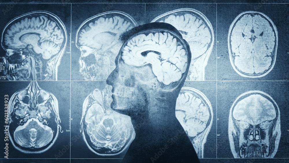 Human head on CT scan with brain background. Overlay on old paper ...