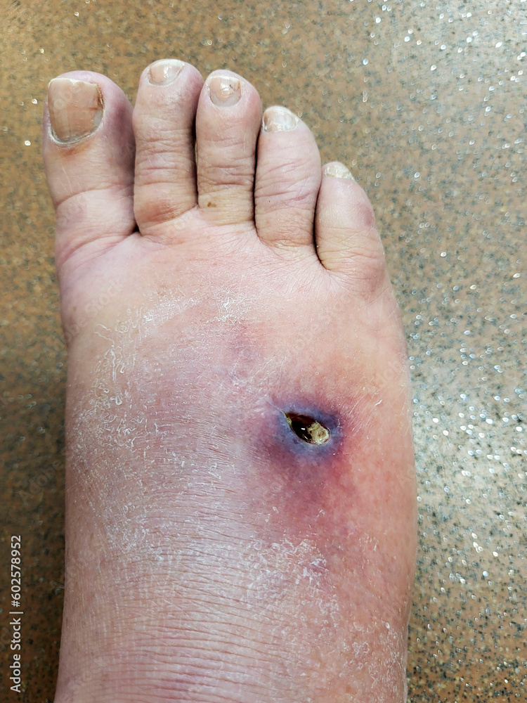 Stockfoto Stingray whip injury resulting in infection and tissue ...