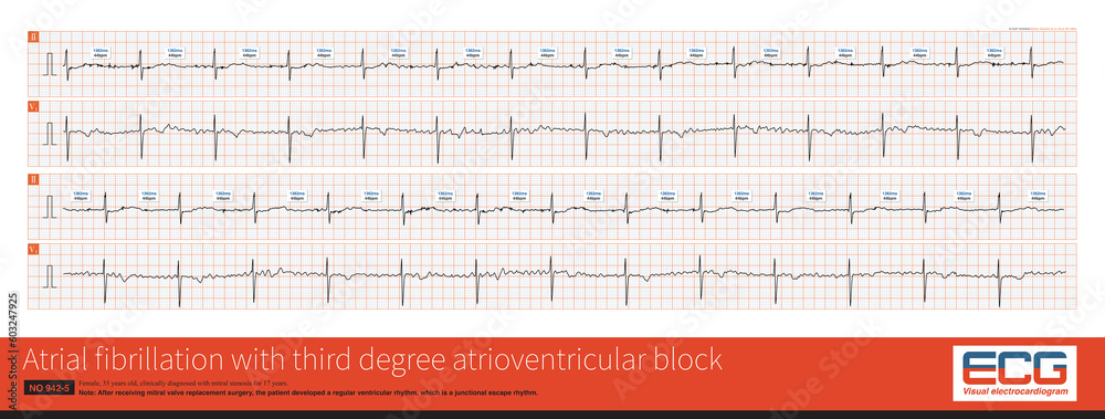 Cardiac surgery is one of the common causes of iatrogenic ...