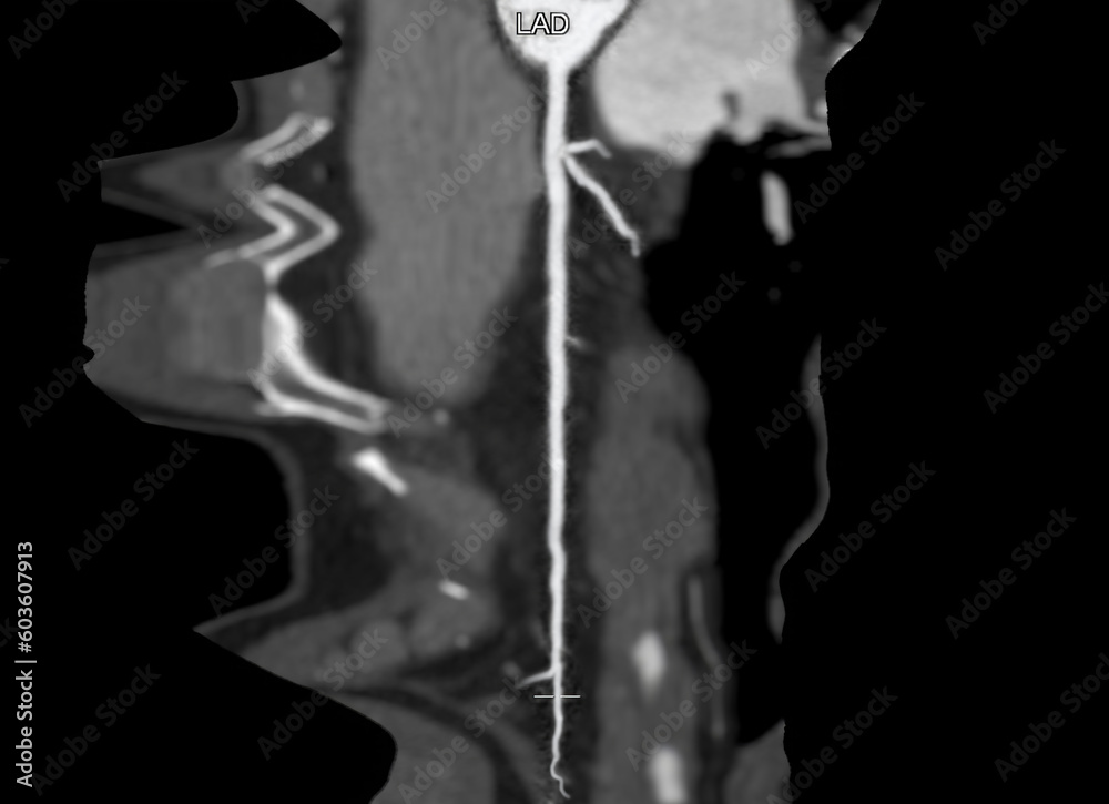 CTA coronary artery Curve refomation showing left coronary artery ...