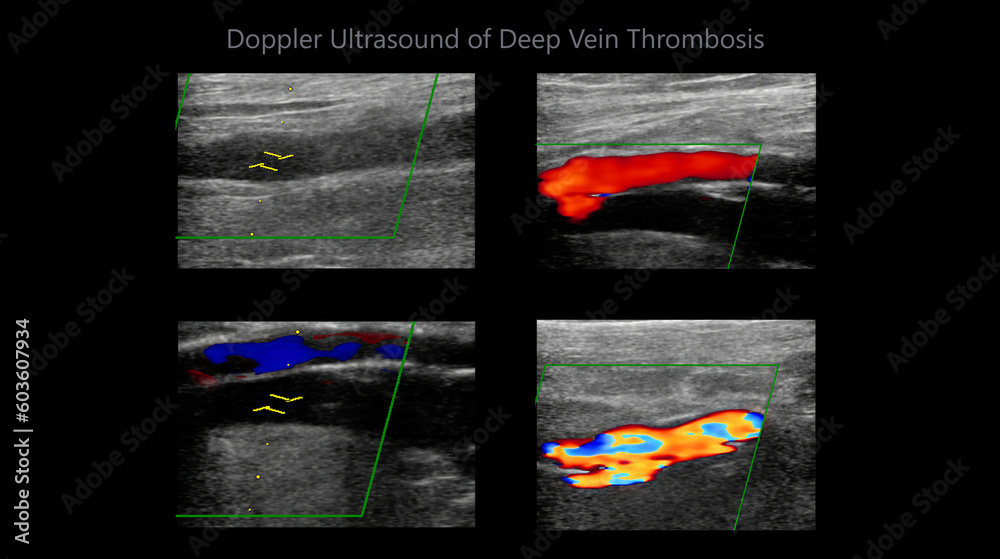 Color Doppler ultrasound determination in deep vein thrombosis patients ...