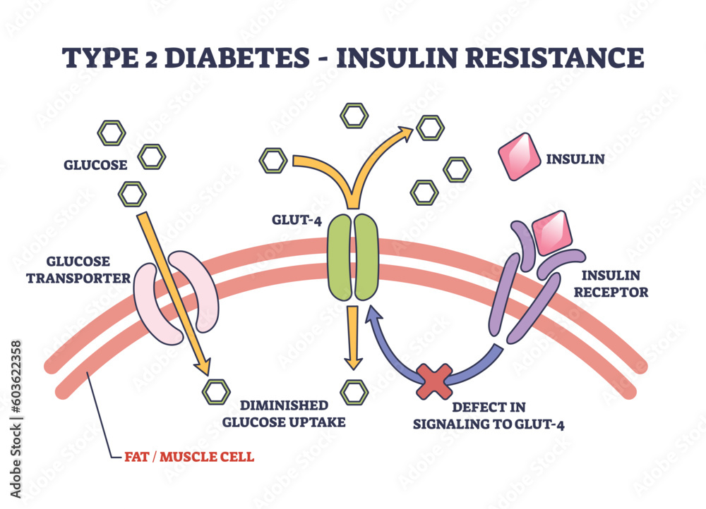 Type 2 diabetes and insulin resistance anatomical explanation outline ...