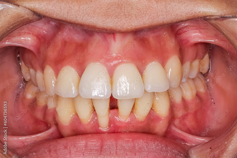 Front view of dental arches in occlusion, lips and cheeks retracted ...
