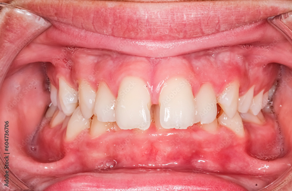 Dental maxillary and mandibular arches in occlusion with biting teeth ...