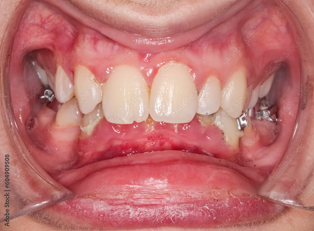 Stock-Foto „Frontal view of dental maxillary and mandibular arches in ...