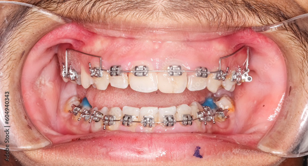 Frontal view of open mouth dental arches with deep overbite biting ...