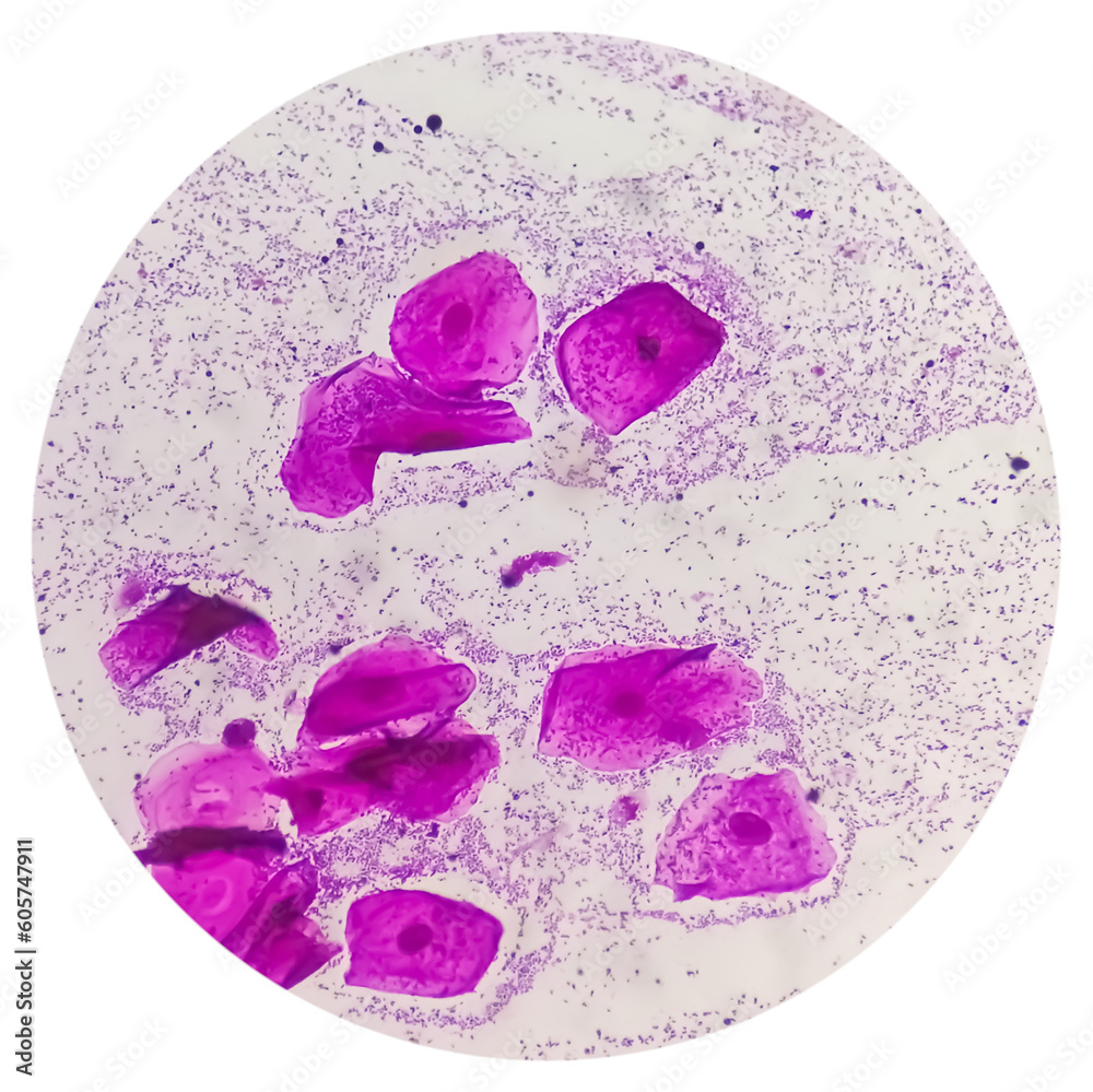 High Vaginal Swab (HVS) Gram Stain: Photomicrograph showing Bacterial ...